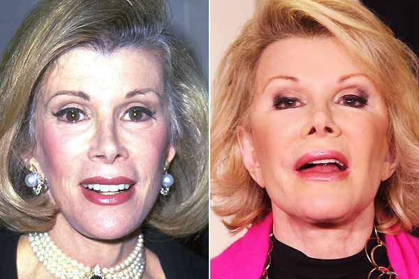 Top 5 Jokes From Joan Rivers Roast, Not One About Fraxel repair | Dr ...