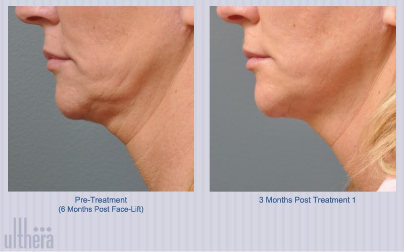 Trancutaneous Focused Ultrasound (Ultherapy, Ulthera) for Non-Invasive ...