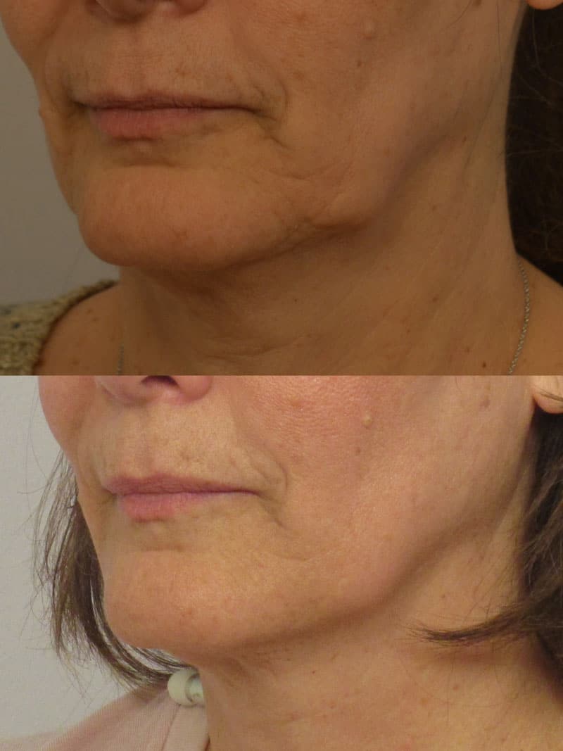 Profound™ Lift in Encino, CA - San Fernando Valley & Encino - Dr ...