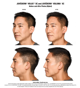 Jawline Contouring With JUVÉDERM® VOLUX™ XC in Encino, CA - San ...